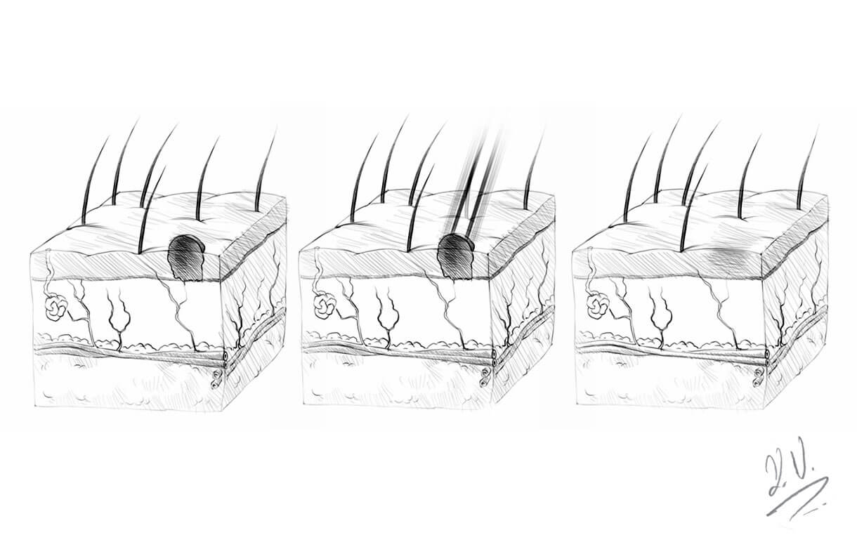 Skin lesion removal with laser