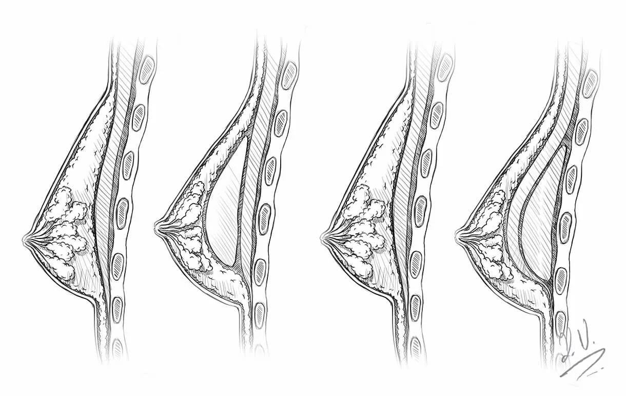 Breast Surgery | Confidence Through Natural Results