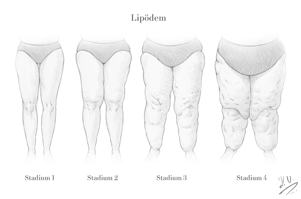Lipödem: Ursachen, Symptome & moderne Behandlung